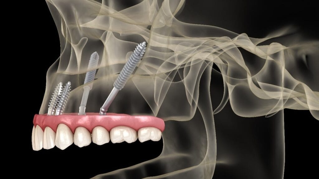 Zygomatic Implants: Your Key to a New Smile and Renewed Confidence