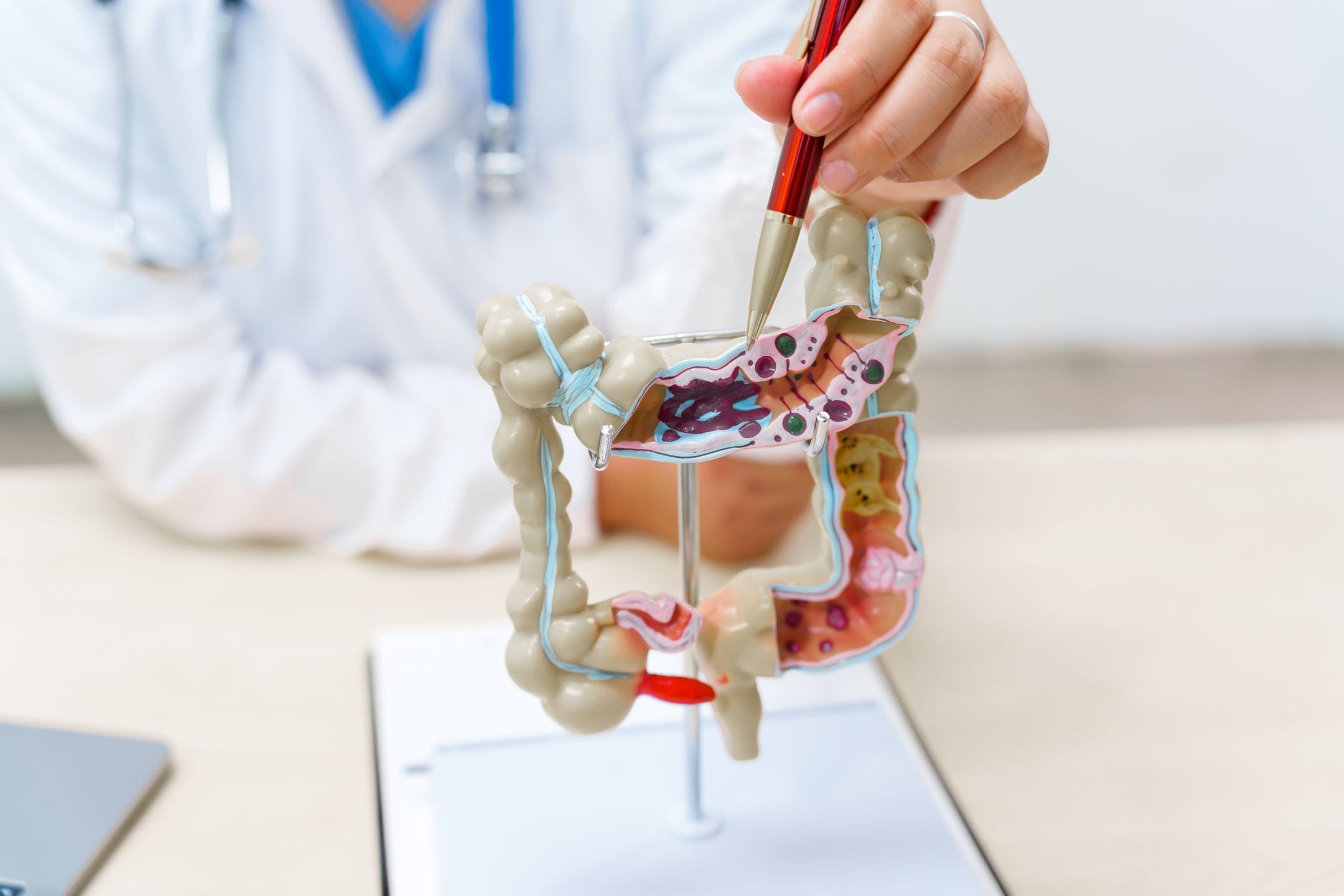 What Are Polyps of the Colon? Causes and Treatment Options